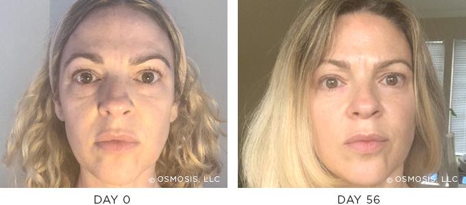 other-ba-le-recovery | Skin2Envy